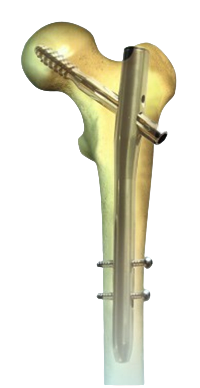 La vie avec un clou intramédullaire - EgiFix Medical